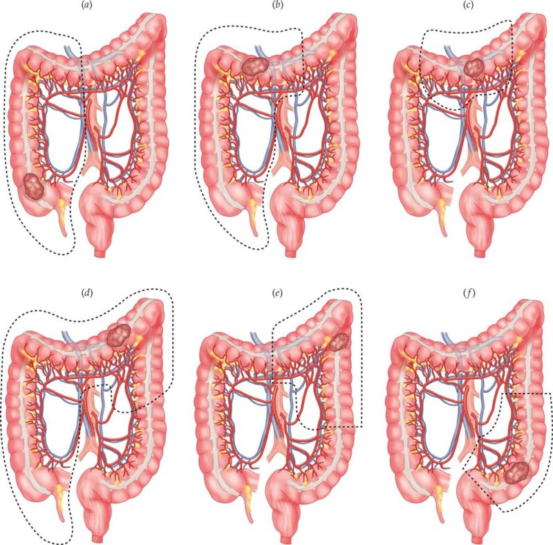 Tumori del colon-retto - Dr. Andrea Lucchi Specialista in Chirurgia Laparoscopica e Minivasiva